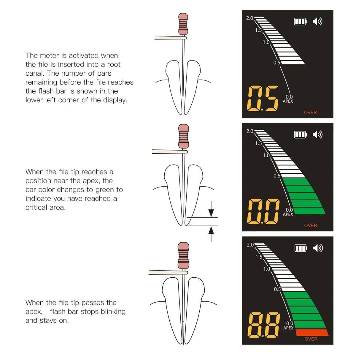 Dental Endo Root Cancal Apex Locator Автоматично калибриранеосигурява ...
